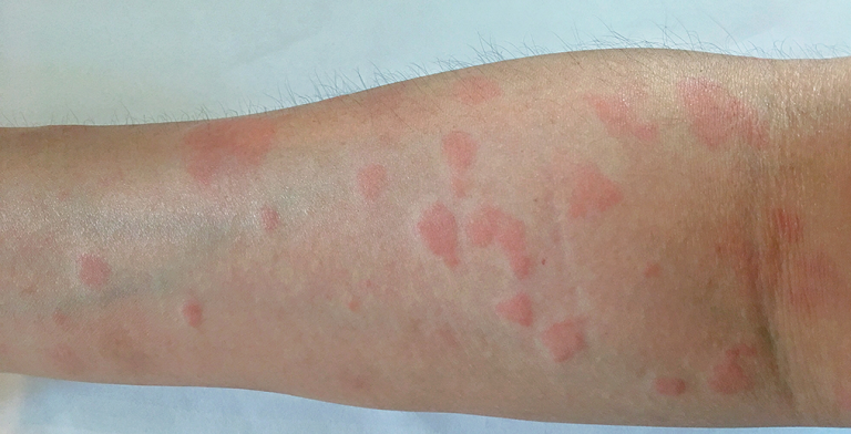 Simptome, cauze si tratament pentru boala autoimuna | poliana.ro | Blog