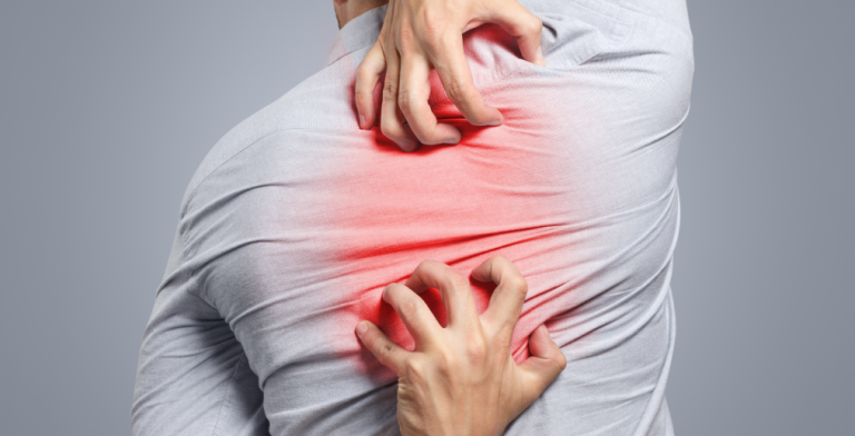 Scabia (raia): simptome, tratament si metode de preventie - Policlinica ...