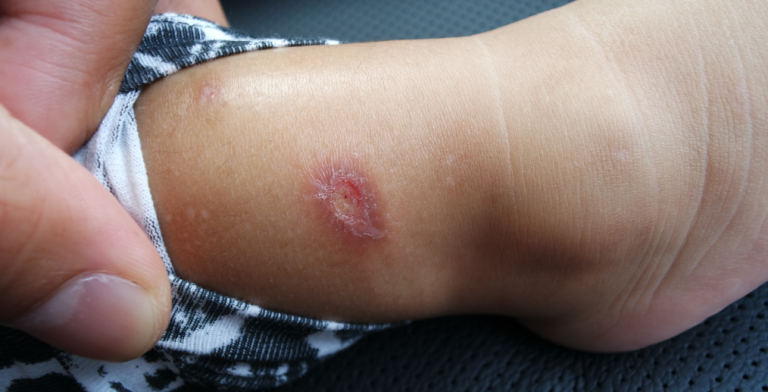 Scabia (raia): simptome, tratament si metode de preventie - Policlinica ...