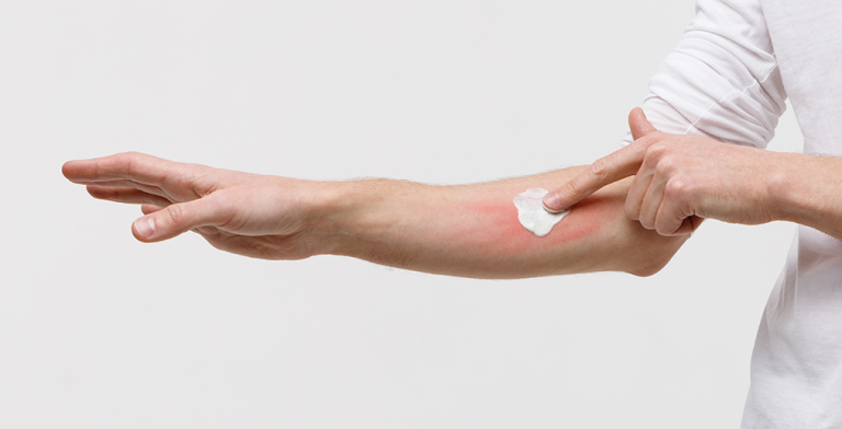 Raia: simptome si masuri de prevenire a infectiei | Poliana.ro | Blog