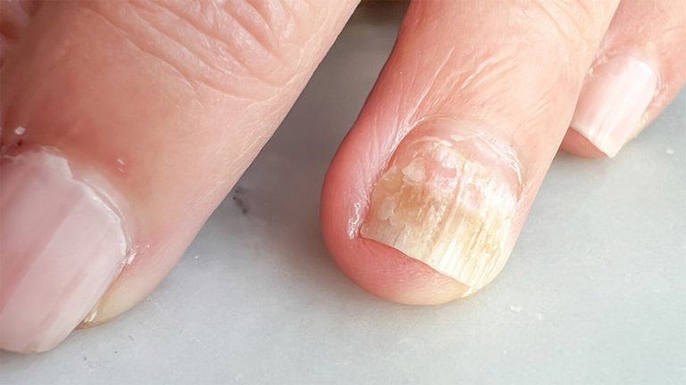 Ciuperca unghiei (onicomicoza): simptome, diagnostic, tratament