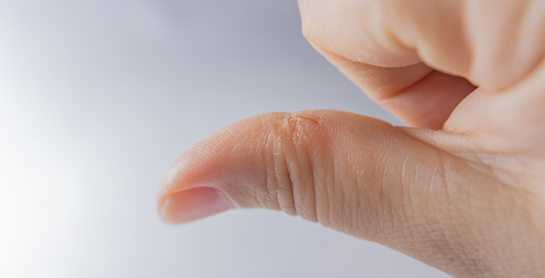 Dishidroza - cauze, manifestari, tratament - Policlinica Analize ...