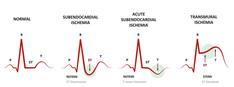 Infarctul miocardic: cauze, diagnostic, tratament - Policlinica Analize ...