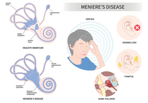Boala Meniere: cauze, simptome, diangostic, tratament - Policlinica ...