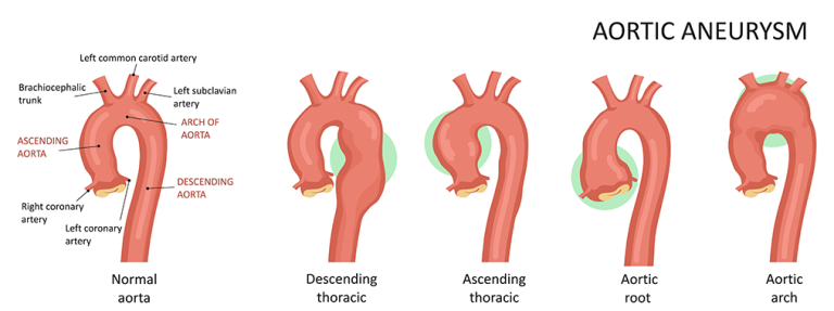 Totul despre anevrisme: ce sunt, cum se manifesta, cum se trateaza ...