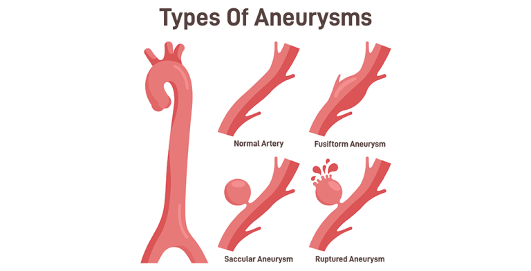Totul despre anevrisme: ce sunt, cum se manifesta, cum se trateaza ...