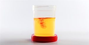 Hematii in urina (hematurie): cauze si tratament - Policlinica Analize ...