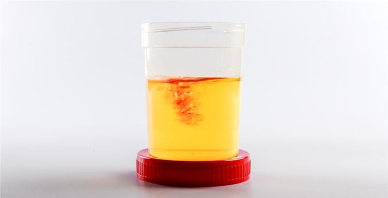 Hematii in urina (hematurie): cauze si tratament - Policlinica Analize ...