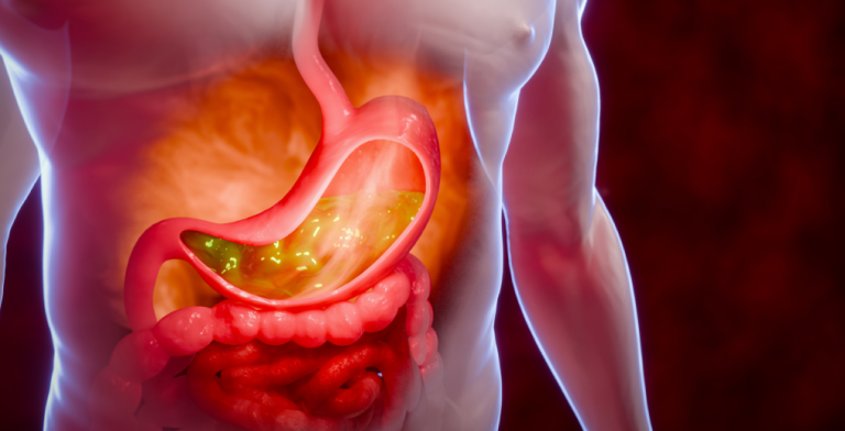 Boala de reflux gastroesofagian (BRGE): simptome, diagnostic, tratament ...